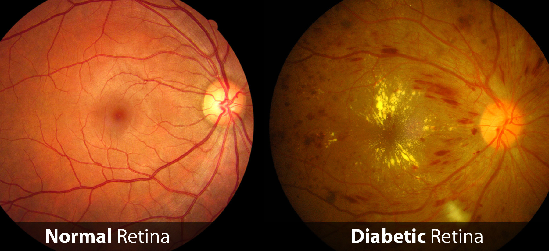 Diabete E Salute Dell occhio Oculus Centro Oculistico Laser